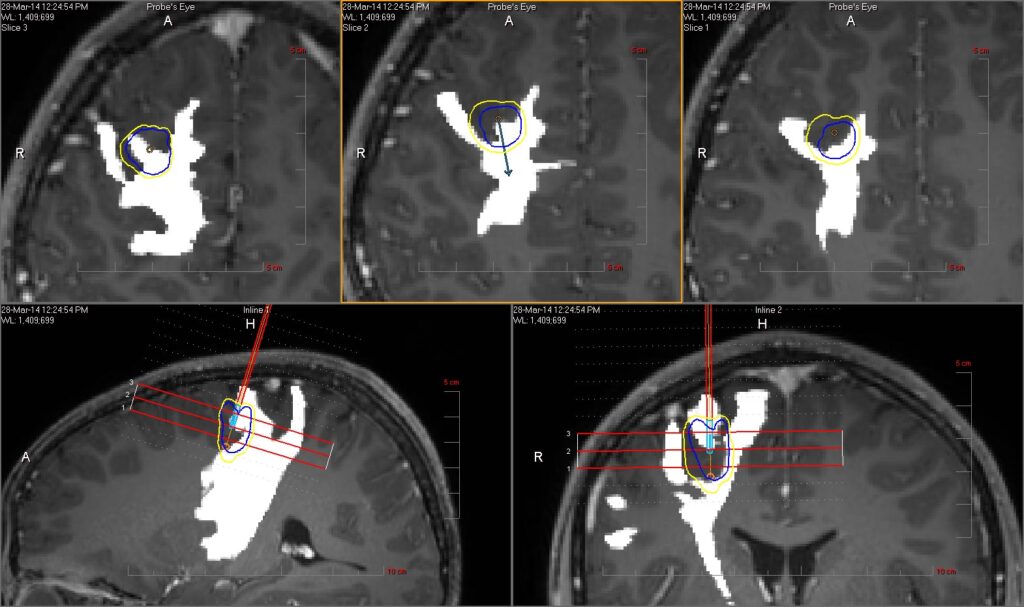 NB3 Case Insights - Monteris