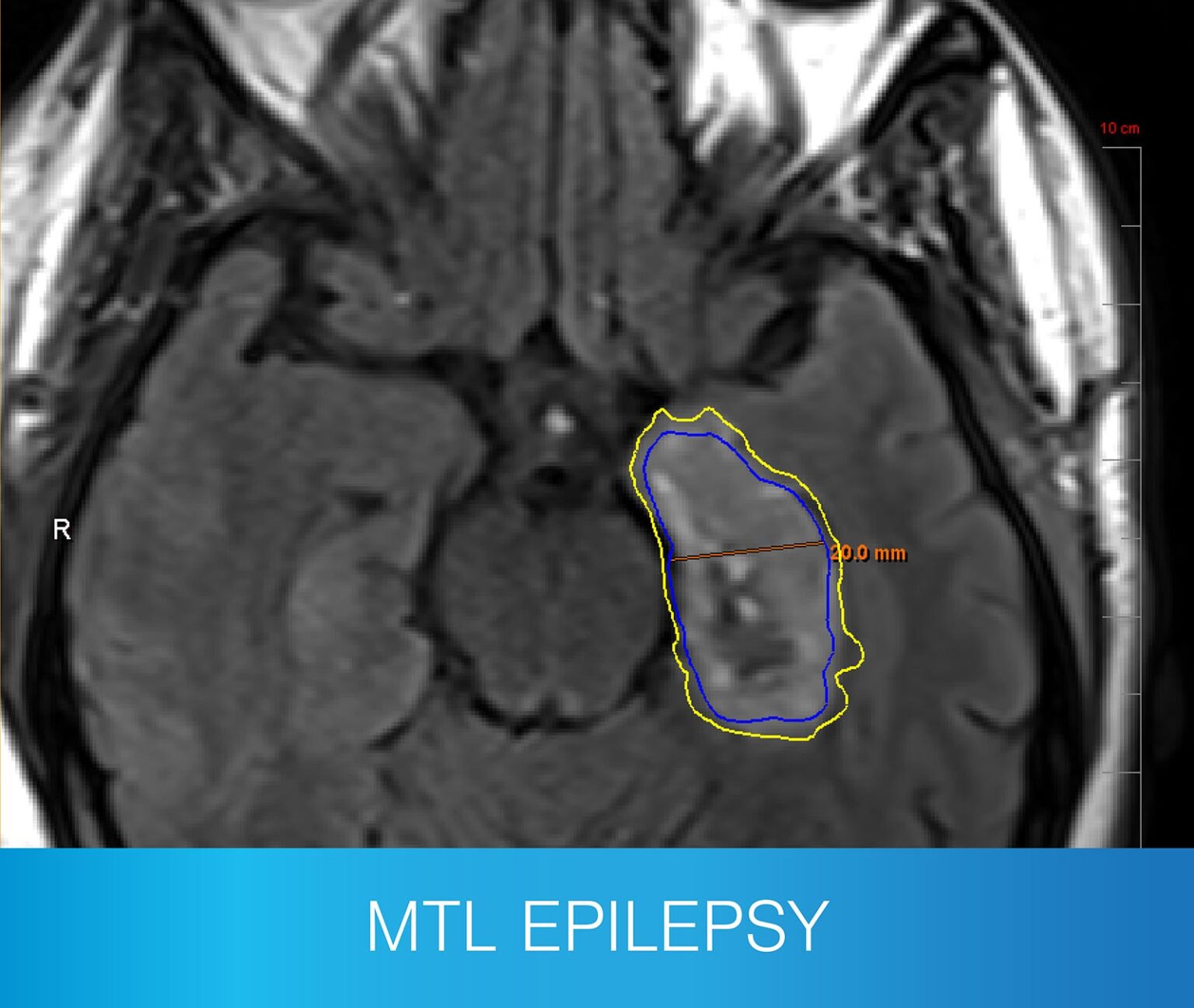 The NeuroBlate® Laser Ablation System | Monteris